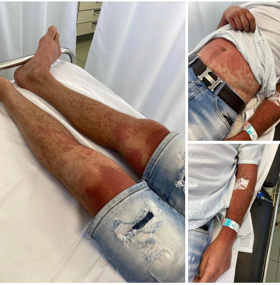 Nolotil En Mallorca Hay Cuatro Afectados Por Sus Efectos Secundarios