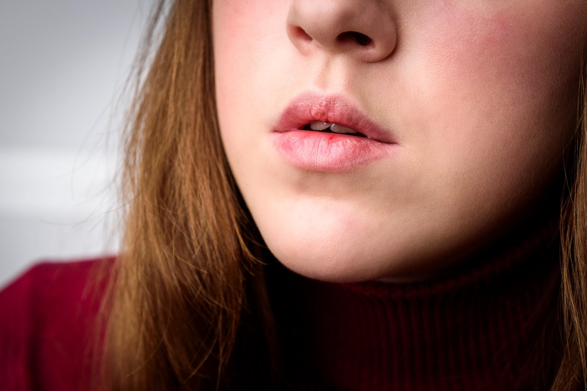 Todo lo que necesitas saber para cuidar tus labios secos en invierno