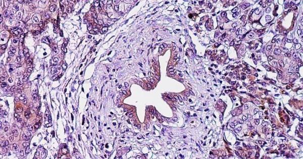 Cáncer de páncreas: nuevo tratamiento autodestruye las células malas