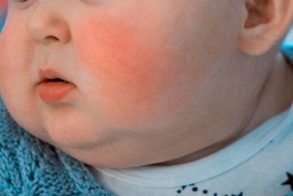 El virus ‘de la bofetada’ en Mallorca pega entre los menores de diez años